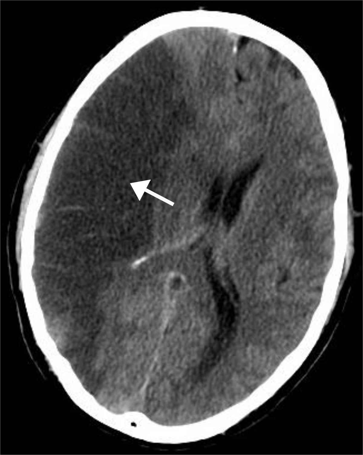 Ischemic Stroke Ischemic Stroke